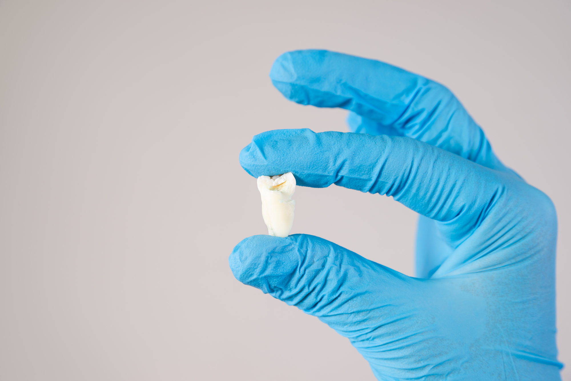 Expert Wisdom Tooth Removal | Comfortable Care at Hamilton Dental Group